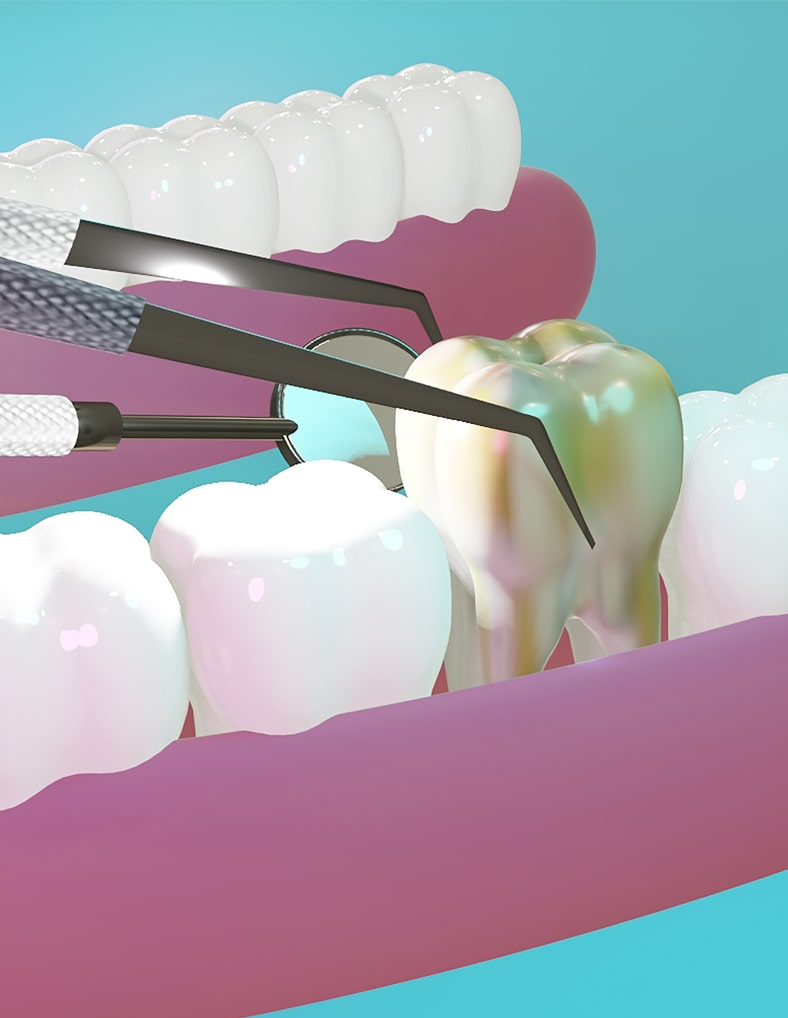 Single Dental Implants - Abbey Mead Dental & Implant Clinic